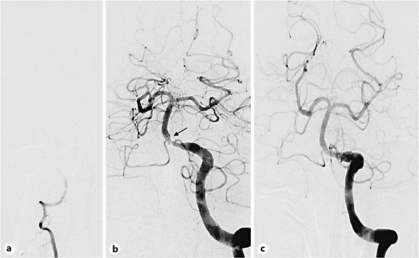 of Transient Ischemic Attack | Neupsy Key