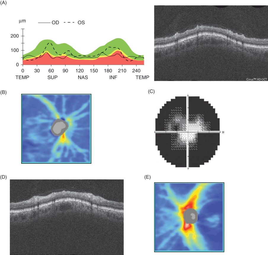 Optical coherence tomography in acute optic neuritis | Neupsy Key