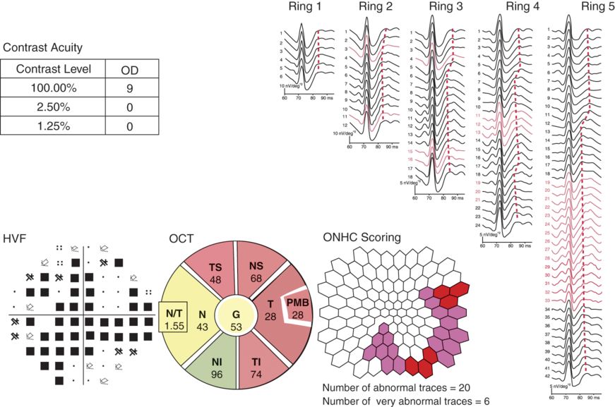 Optical coherence tomography and electrophysiology of the optic nerve ...
