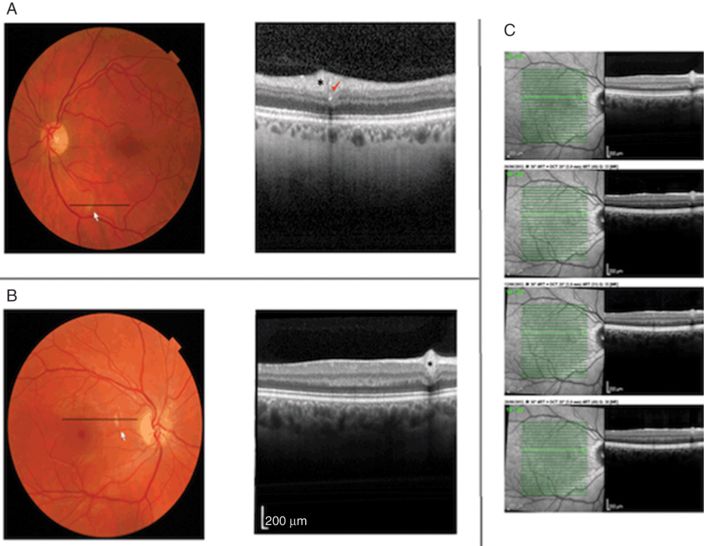 Retinal inflammation in multiple sclerosis revealed by optical ...