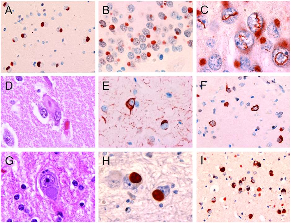 Neuropathology of frontotemporal dementia and related disorders ...