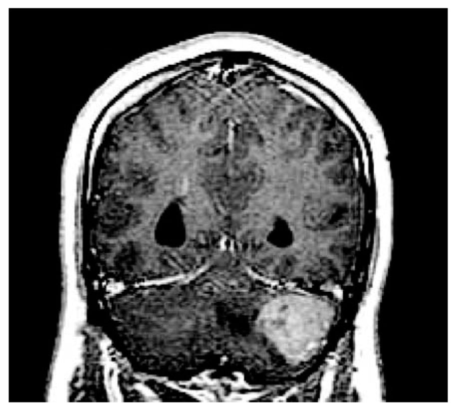 Primary Central Nervous System Tumors | Neupsy Key