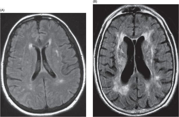 CADASIL: a genetic model of arteriolar degeneration, white matter ...