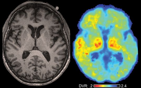 Chronic traumatic encephalopathy | Neupsy Key