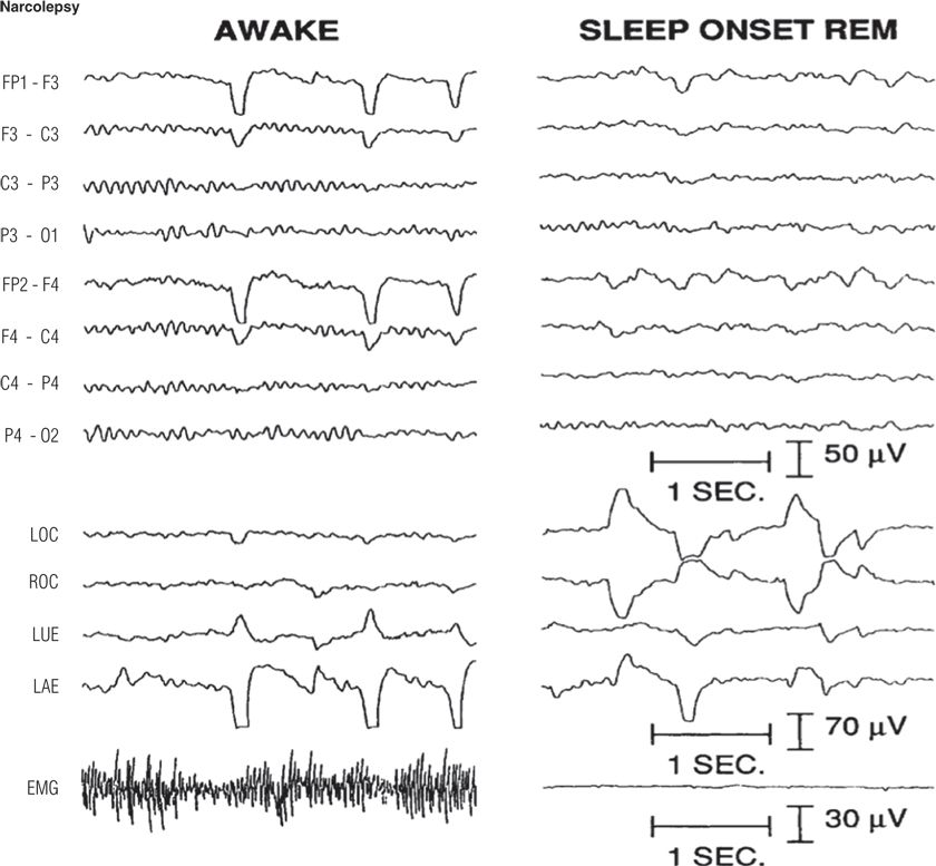 Electroencephalographic Atlas Of Epileptiform Abnormalities Neupsy Key