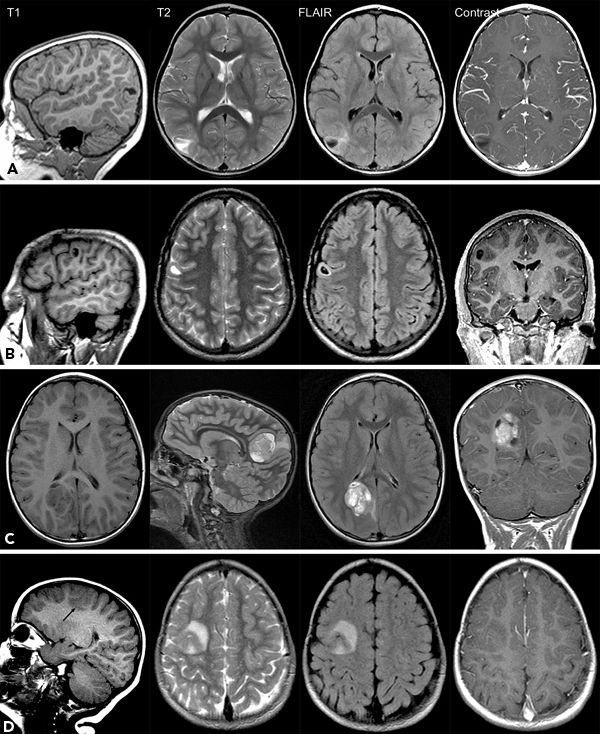 Magnetic Resonance Imaging in Evaluation for Epilepsy Surgery | Neupsy Key