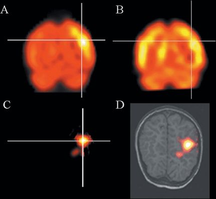 Nuclear Imaging (PET, SPECT) | Neupsy Key