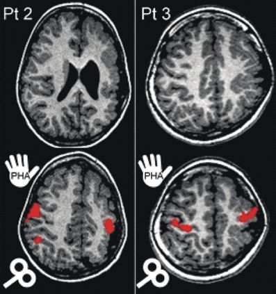 Mapping Motor Function | Neupsy Key