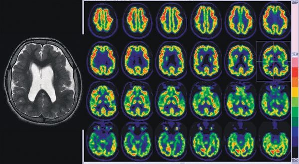 Surgical Approach in Multilesional or Multilobar Epilepsies | Neupsy Key