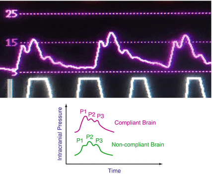 Intracranial Pressure Management | Neupsy Key
