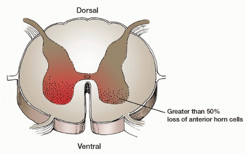Evaluation Of Nerve Root Lesions Involving The Trunk And Lower Extremity Neupsy Key Evaluation Of Nerve Root Lesions Involving The Trunk And Lower Extremity Neupsy Key