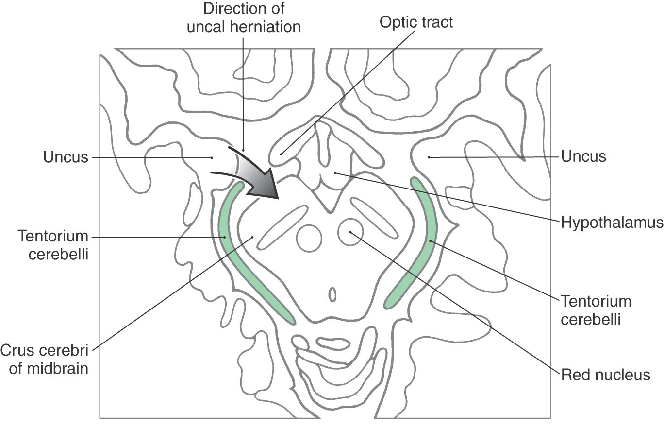 An Overview of the Brainstem | Neupsy Key