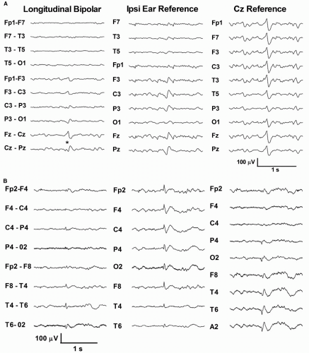 Recording the EEG | Neupsy Key