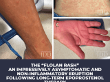 The Flolan Rash Great Cases From The Jdd Next Steps In Dermatology