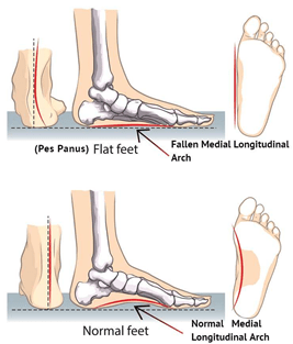 3 Exercises That May Reduce Pes Planus – Nolaro24 Blog