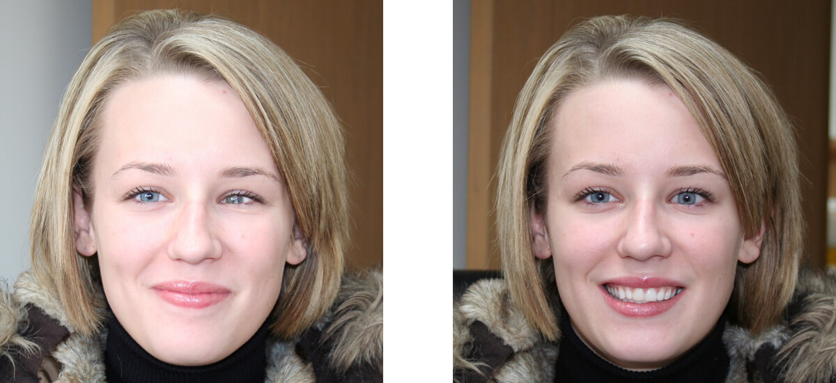 Is a Scleral Shell Right for Me? All About Our Handcrafted Scleral Shells