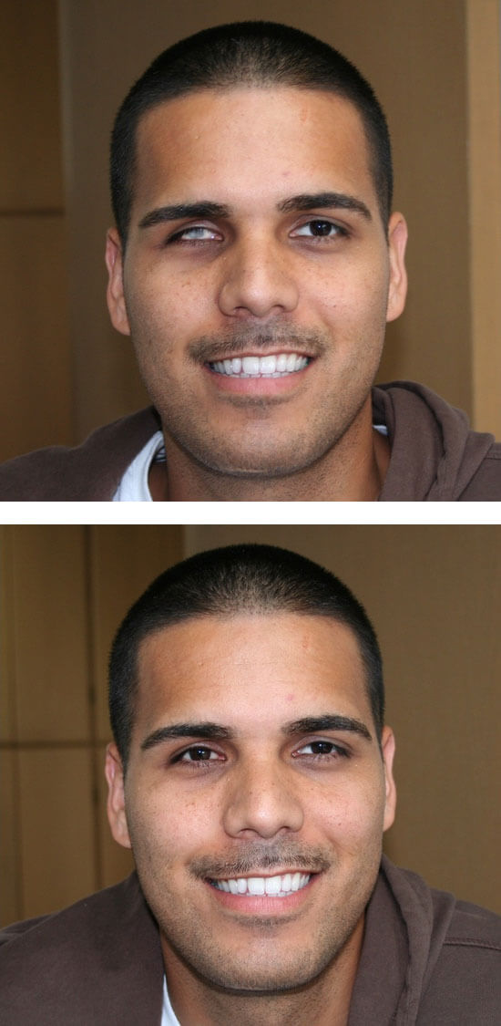 Is a Scleral Shell Right for Me? All About Our Handcrafted Scleral Shells