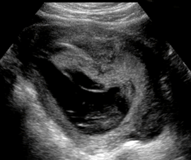 Ultrasound in the First Trimester (All Topics) and Components of Fetal ...