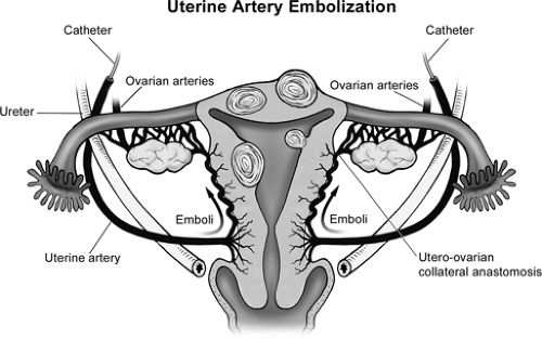 Leiomyomata | Obgyn Key