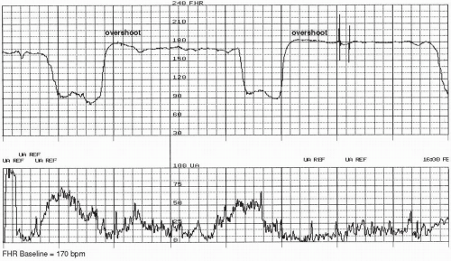 Fetal Heart Rate Pattern Interpretation | Obgyn Key