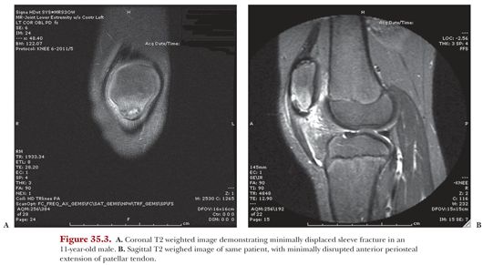 Patella Sleeve Fractures | Obgyn Key