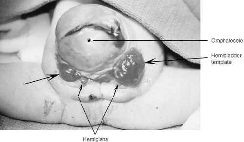 Bladder/Cloacal Exstrophy, and Prune Belly Syndrome | Obgyn Key