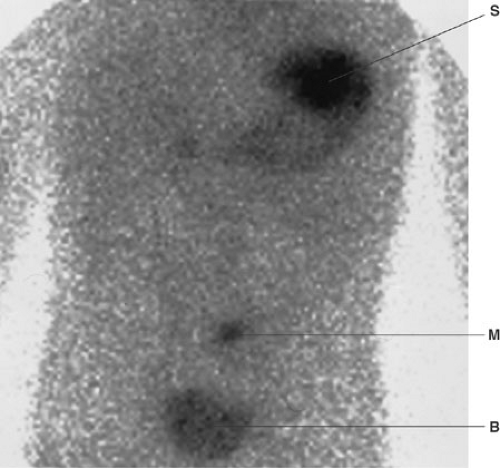Appendix and Meckel’s Diverticulum | Obgyn Key