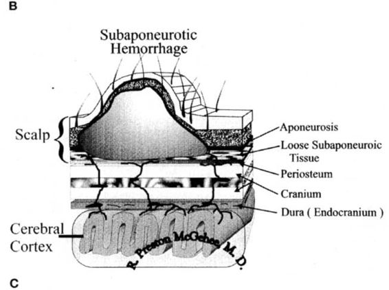 Operative Delivery by Vacuum | Obgyn Key