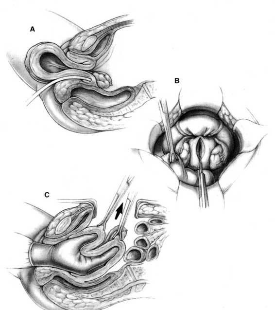 Diagnosis and Management of Uterine Inversion | Obgyn Key
