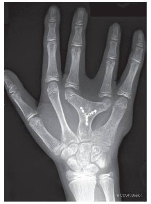 Central Deficiency and Symbrachydactyly | Obgyn Key