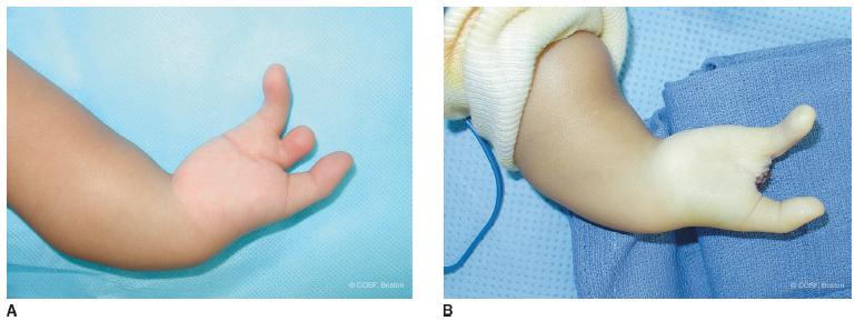 Ulnar Longitudinal Deficiency | Obgyn Key