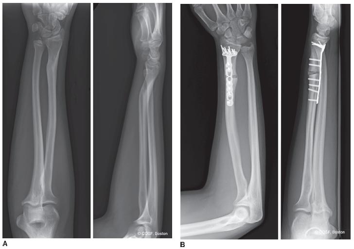 Forearm Fractures | Obgyn Key