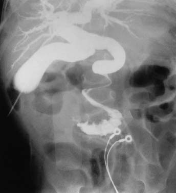Biliary pathology: Miscellaneous | Obgyn Key