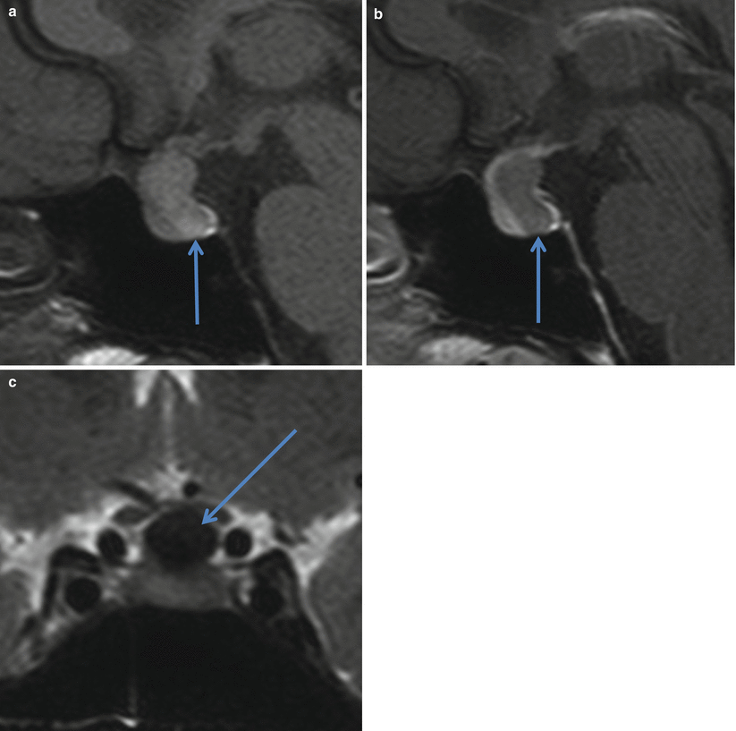 The Sella Turcica | Obgyn Key