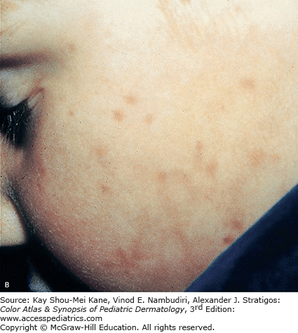 RICKETTSIAL INFECTION | Obgyn Key