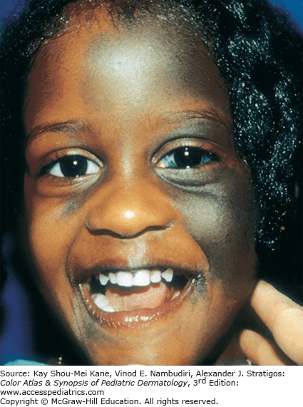 DISORDERS OF MELANOCYTES | Obgyn Key