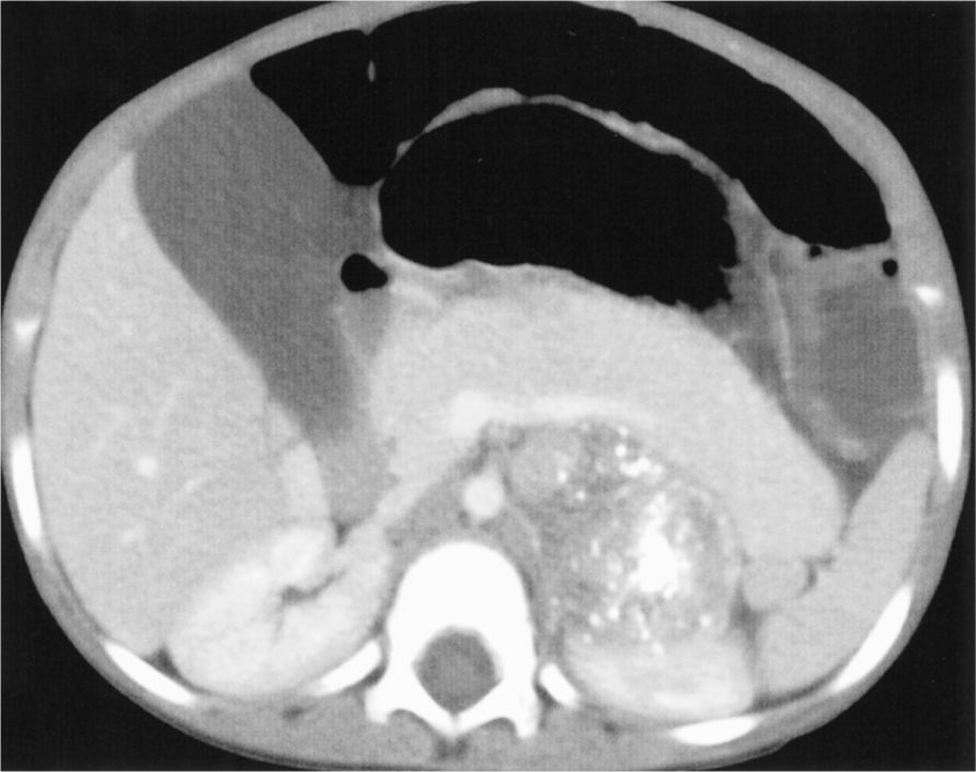 Diarrhea | Obgyn Key