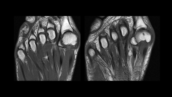 Foot MRI 1st Intermetatarsal Space Pain – OCAD