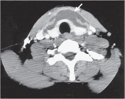 Infectious thyroiditis | Oncohema Key