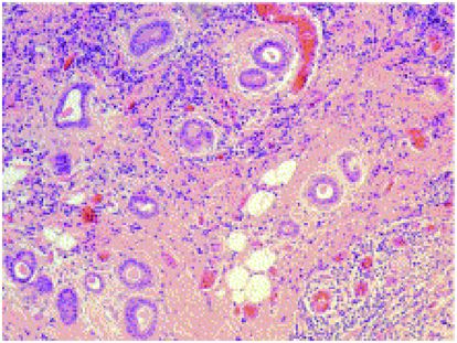 Infection of the salivary and lacrimal glands | Oncohema Key