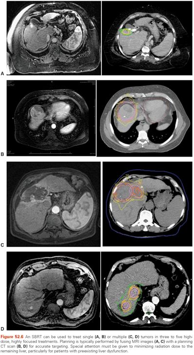 Cancer of the Liver | Oncohema Key