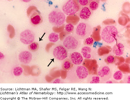 Erythroid Precursors | Oncohema Key