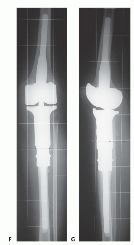 Proximal Tibia Resection With Endoprosthetic Reconstruction Oncohema Key