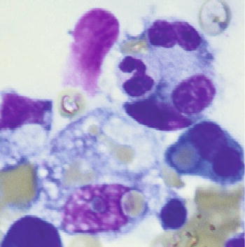 5: Classification of Lysosomal Storage Diseases | Oncohema Key