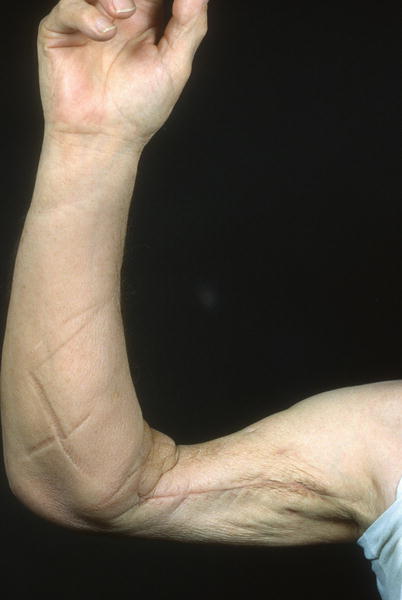 Tumor In The Anterior Compartment Of The Arm Oncohema Key tumor-in-the-anterior-compartment-of-the-arm-oncohema-key