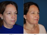 Case 6575 Before After Result Photos