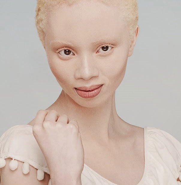 Oreime Zimbabwe Sets Milestone in Africa for Albinism - Oreime