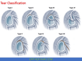 Shoulder Slap Lesion
