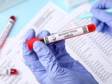 New Billing Codes For Monkeypox Testing And Vaccines Outsource