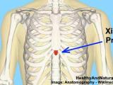 Xiphoid Process Lump Causes Xiphoid Process Syndrome Lgth